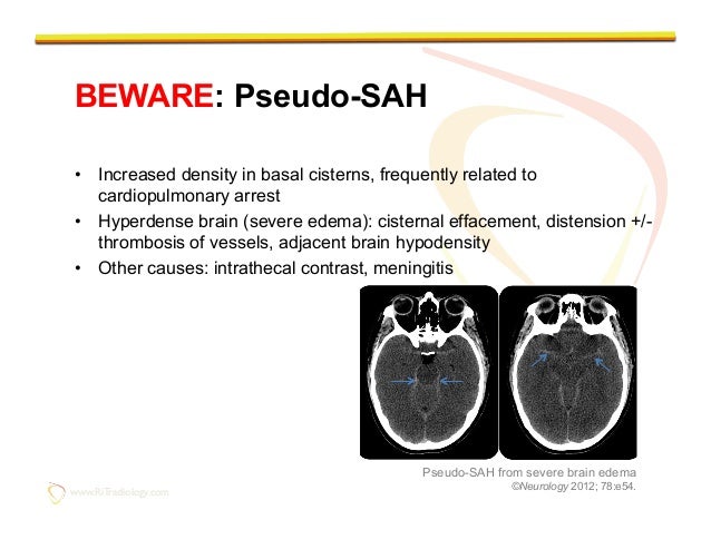 Imaging of Non-traumatic Intracranial Hemorrhage