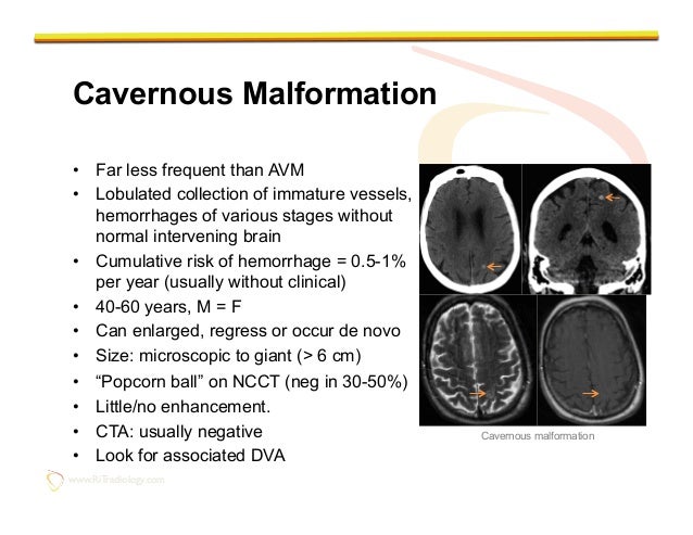 Imaging of Non-traumatic Intracranial Hemorrhage