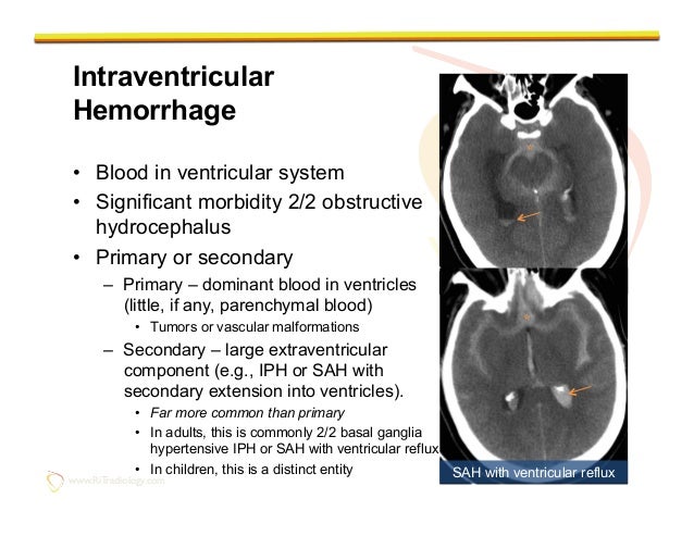 Imaging of Non-traumatic Intracranial Hemorrhage