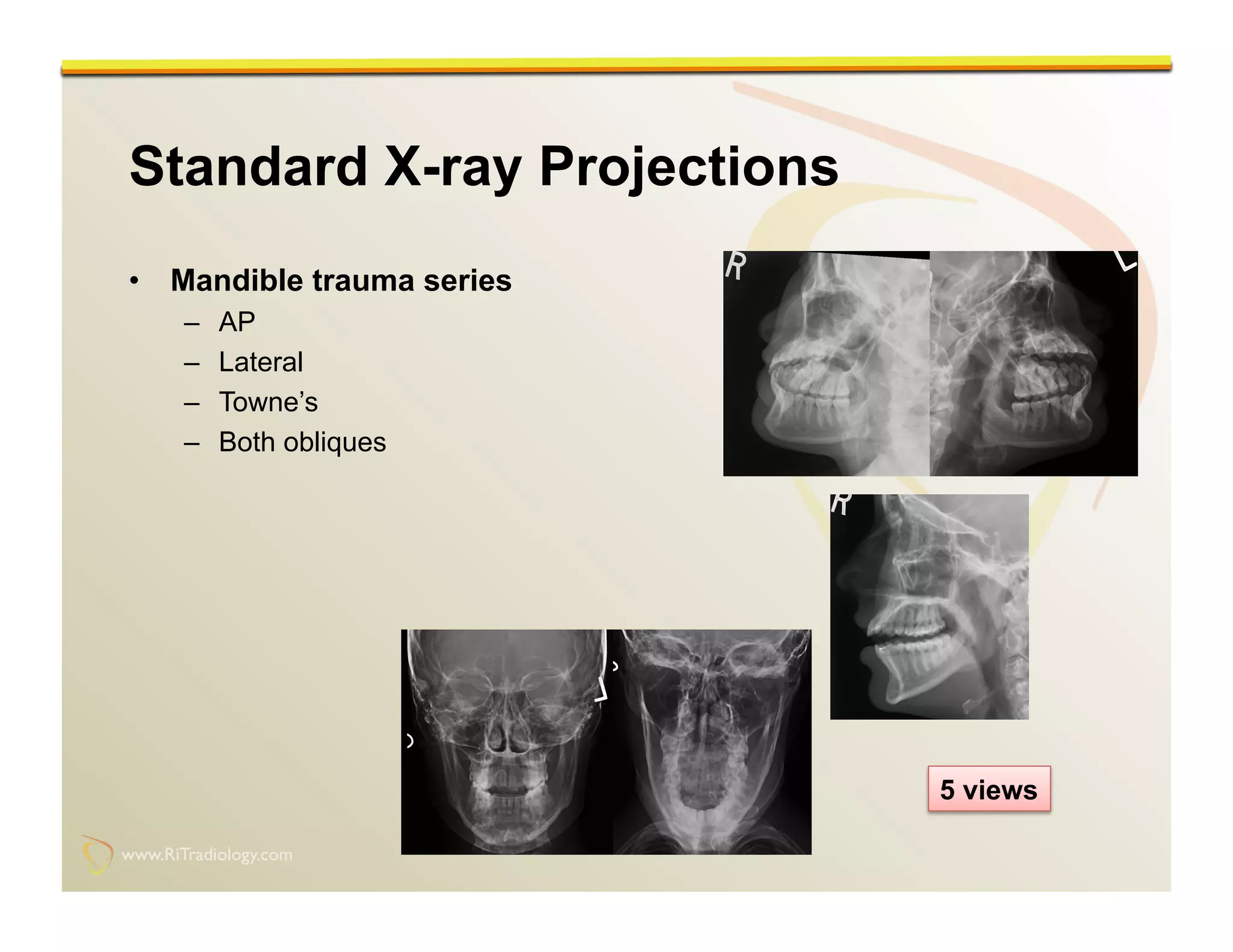 Imaging of Facial Trauma | PDF