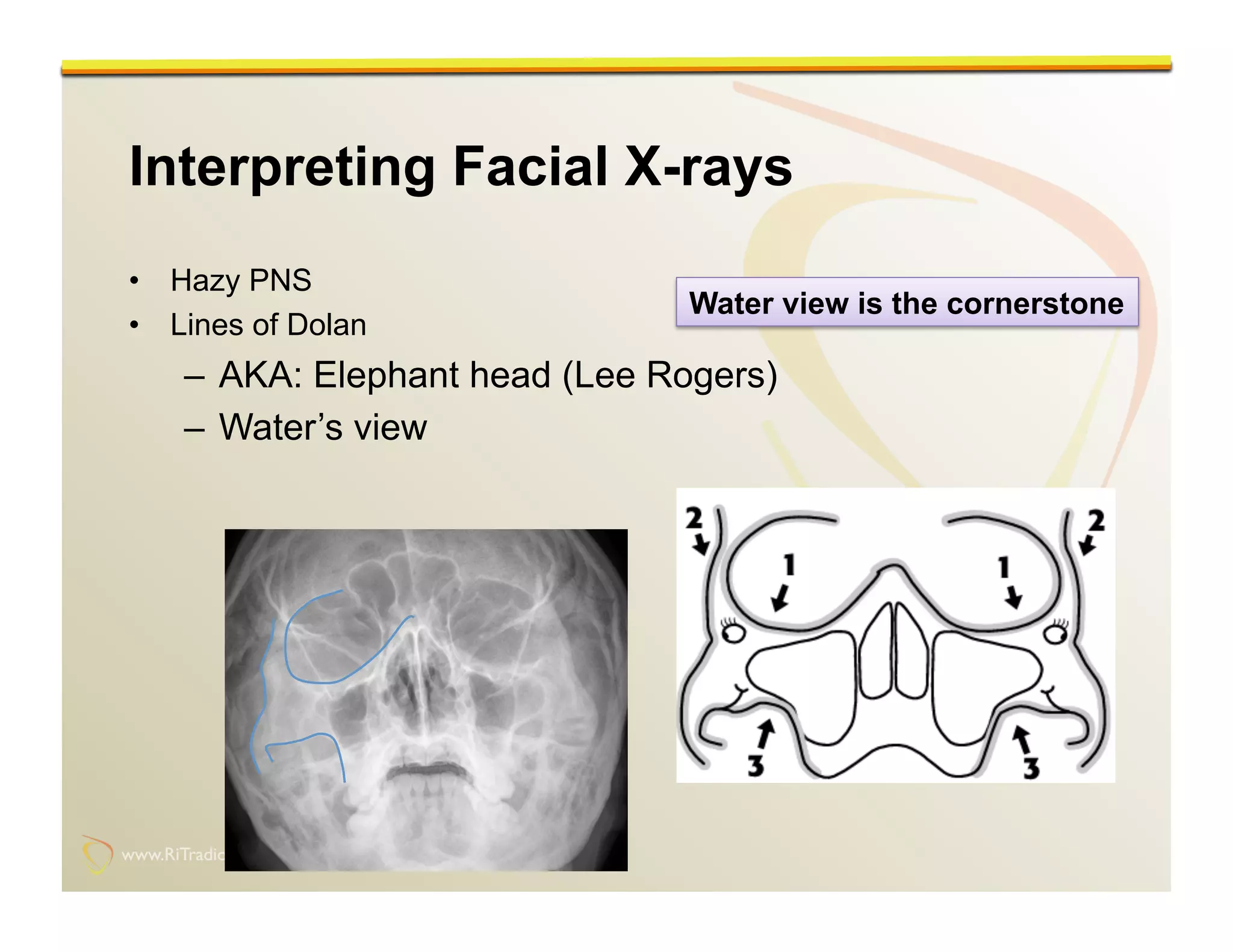 Imaging of Facial Trauma | PDF