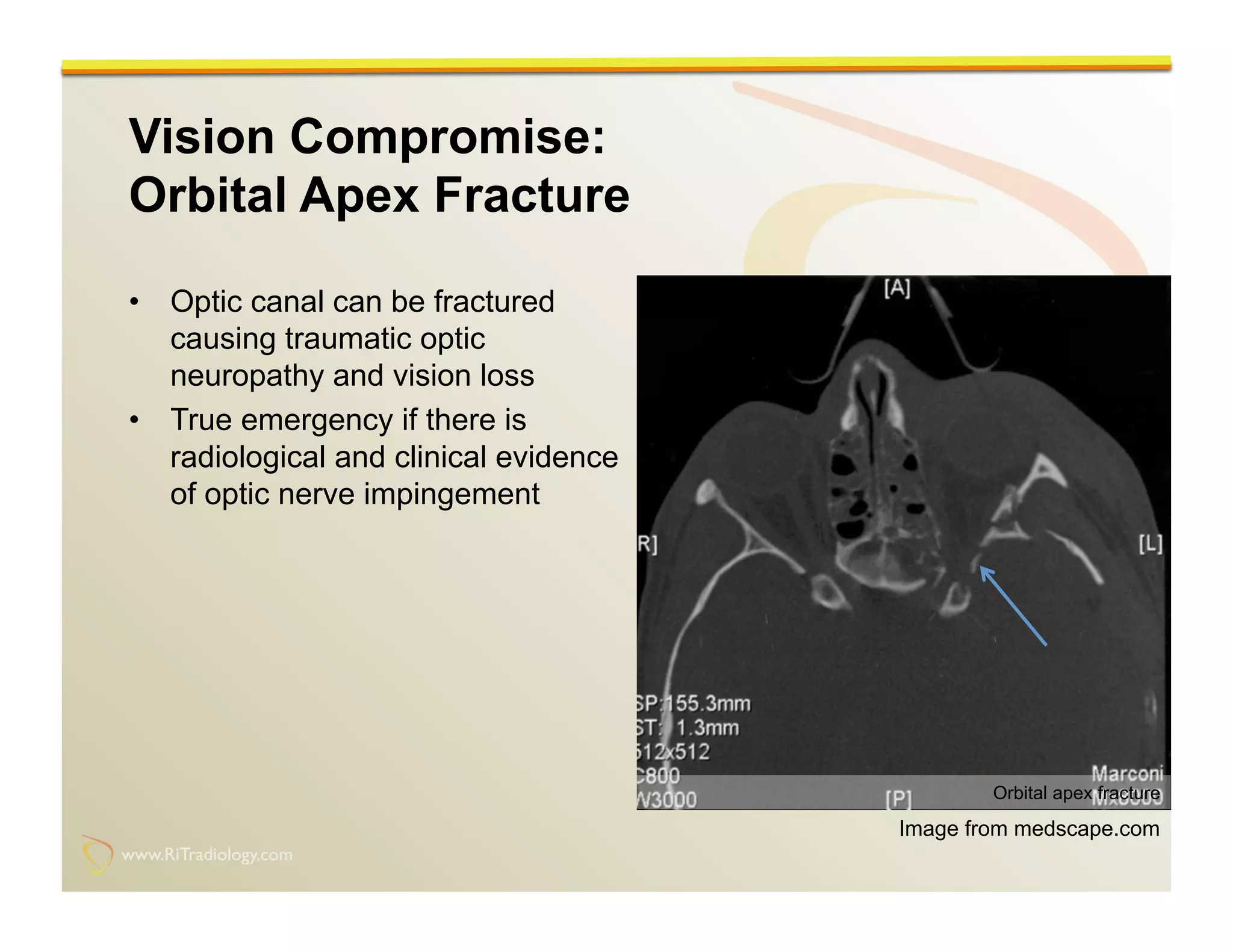 Imaging of Facial Trauma | PDF