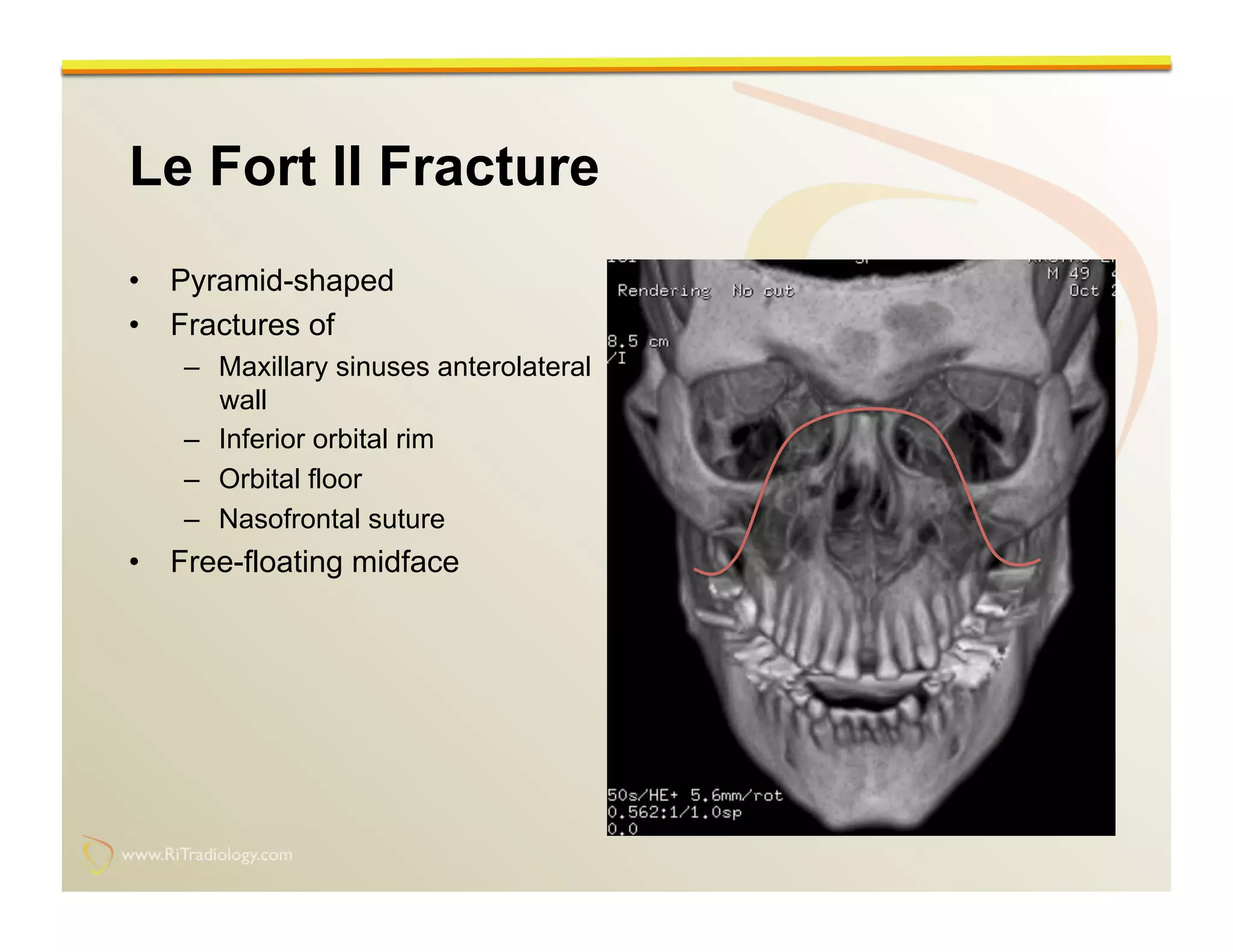 Imaging of Facial Trauma | PDF