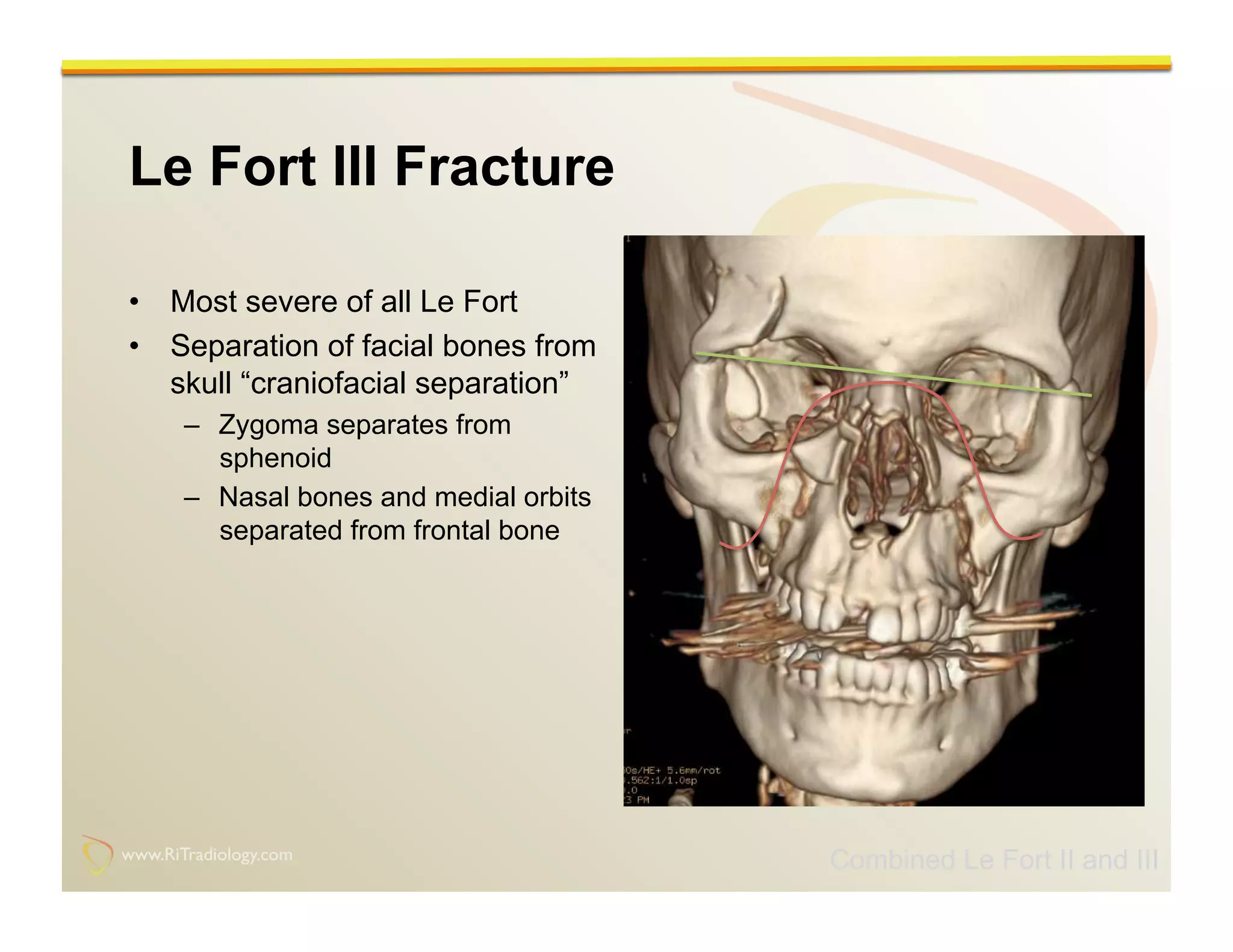 Imaging of Facial Trauma | PDF