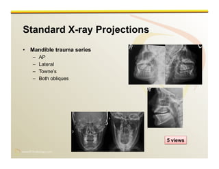 Imaging of Facial Trauma | PDF
