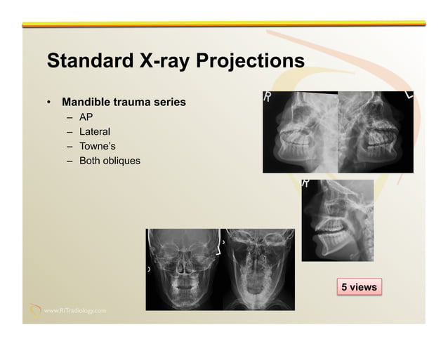 Imaging of Facial Trauma | PDF