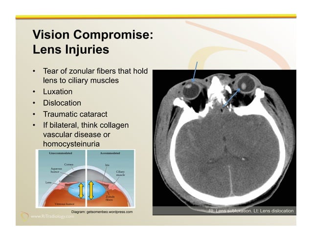 Imaging of Facial Trauma | PDF