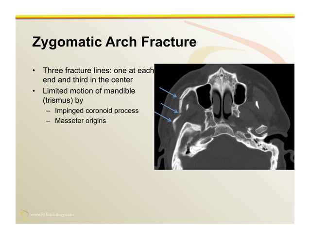 Imaging of Facial Trauma | PDF
