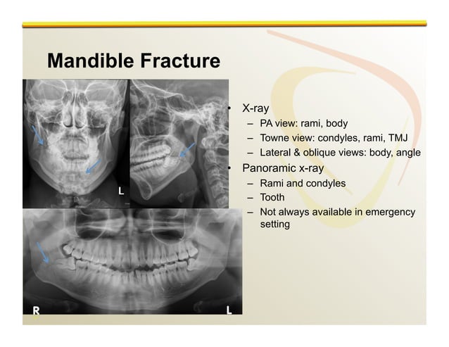 Imaging of Facial Trauma | PDF
