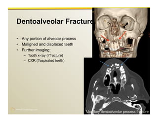 Frontal Process Of Maxilla Fracture