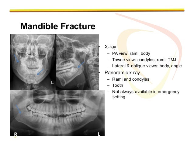 Mandible Fracture X Ray Jaw Fracture Facial Trauma