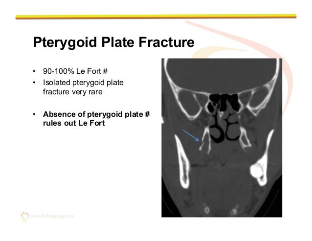 Imaging of Facial Trauma