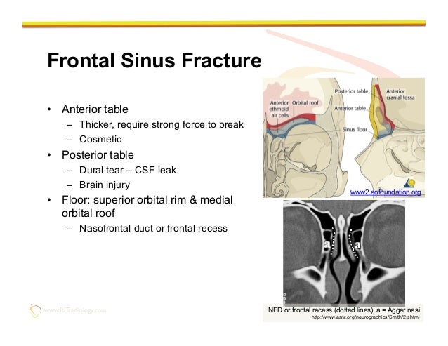 Imaging of Facial Trauma