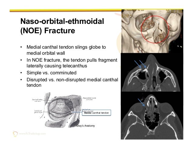 Imaging of Facial Trauma