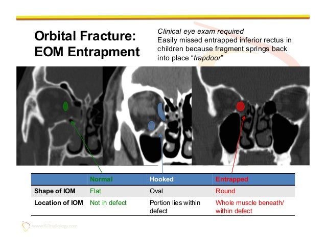 Imaging of Facial Trauma