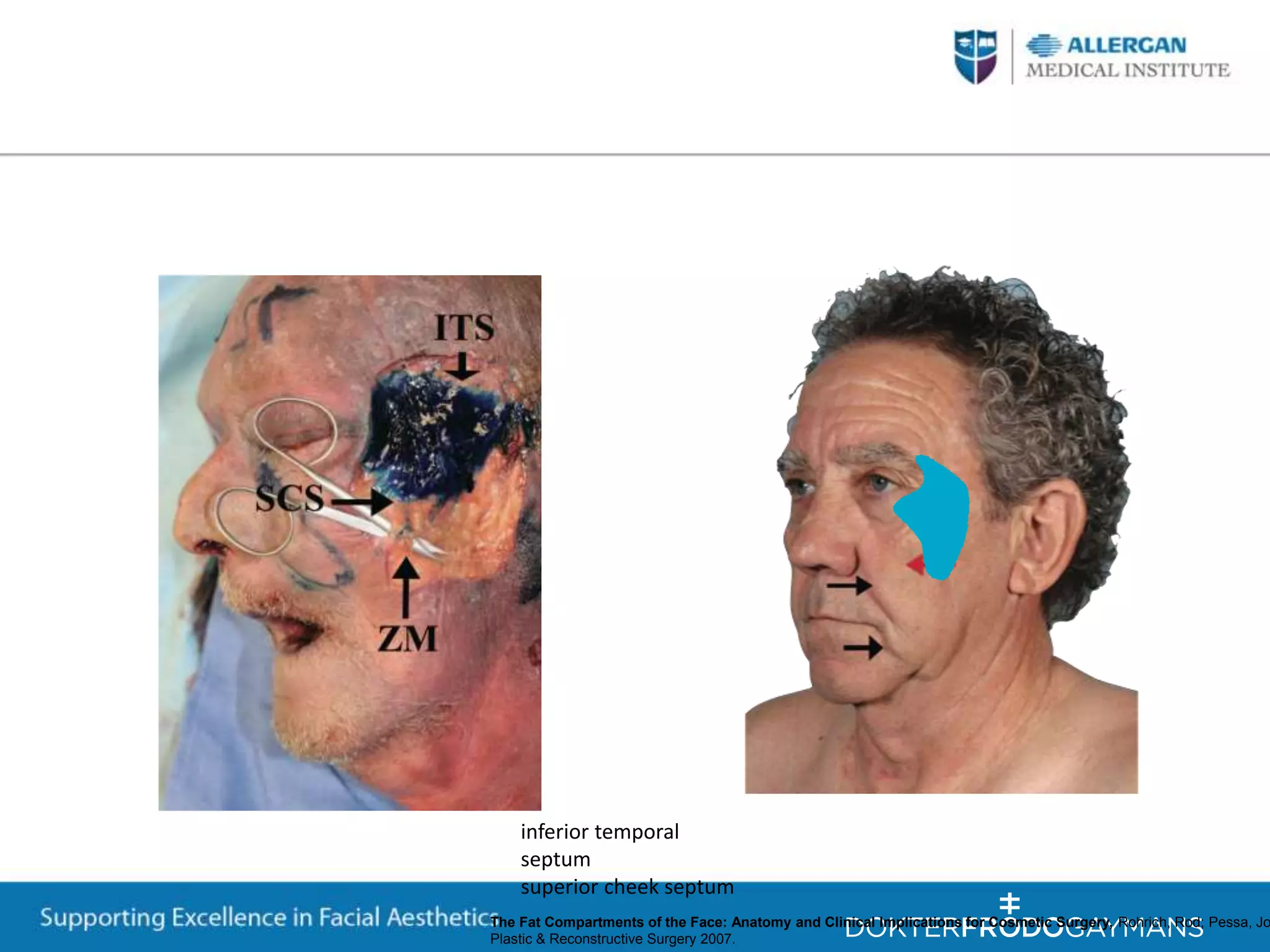 Training for periorbital and upper face treatment with botox and ...