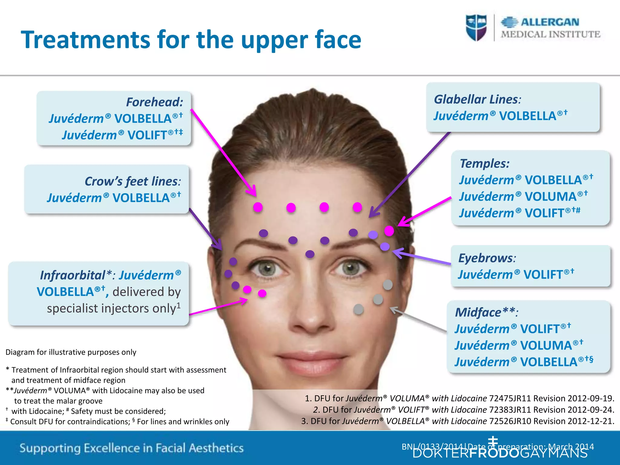 Training for periorbital and upper face treatment with botox and Juvederm | PPTX
