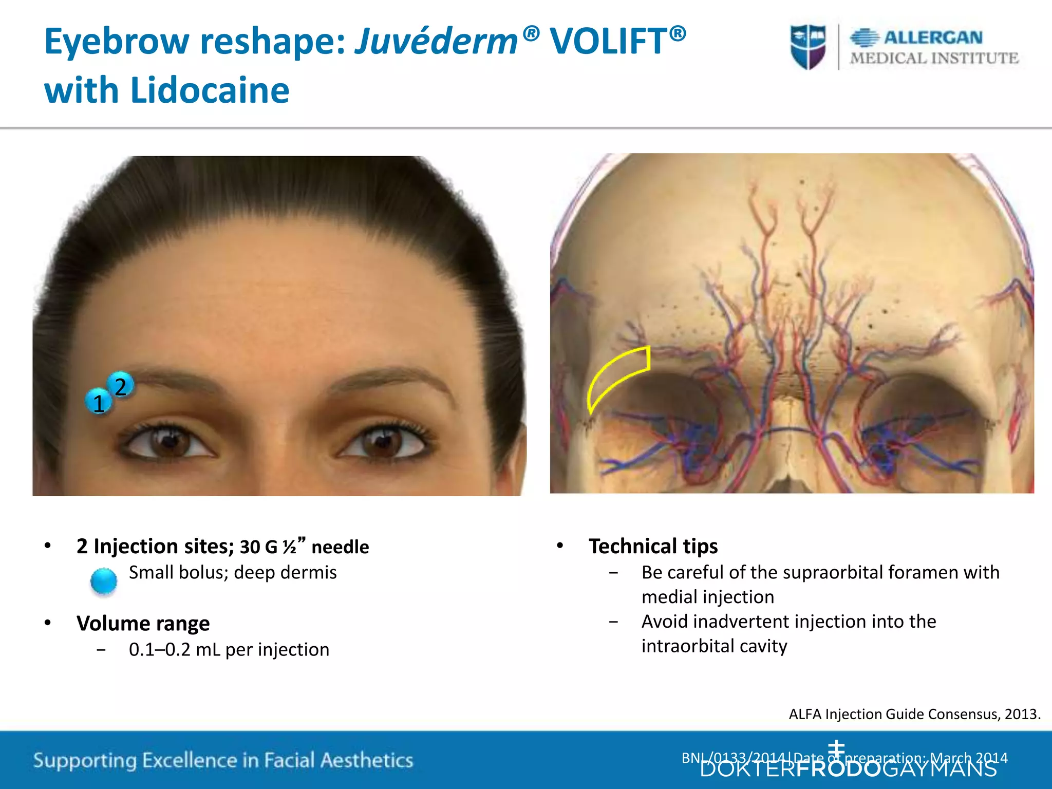 Training for periorbital and upper face treatment with botox and ...
