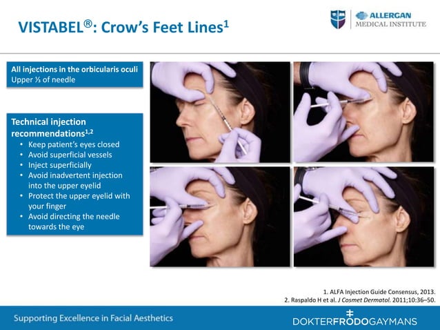 Training for periorbital and upper face treatment with botox and ...