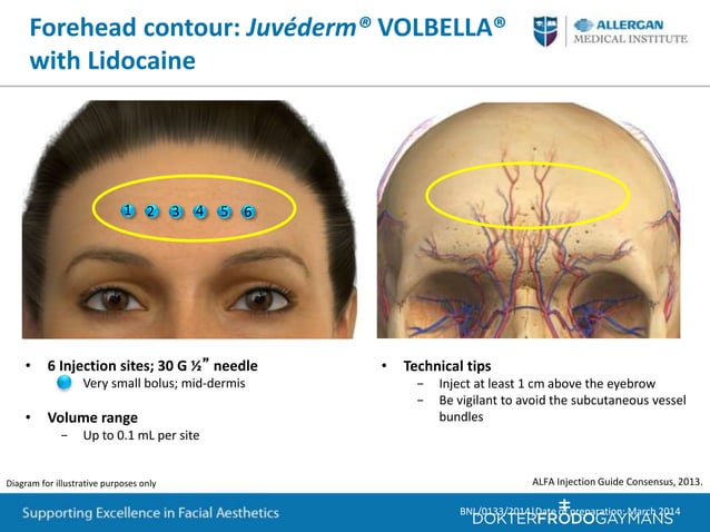 Training for periorbital and upper face treatment with botox and Juvederm | PPTX | Skin and ...
