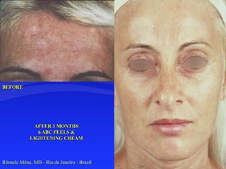 Tratamiento de Hiperpigmentacion com Estrategias de Peeling Combinadas ...
