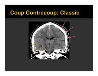 Contrecoup Fracture