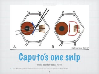 2014 strabismus surgery slmc | PPT