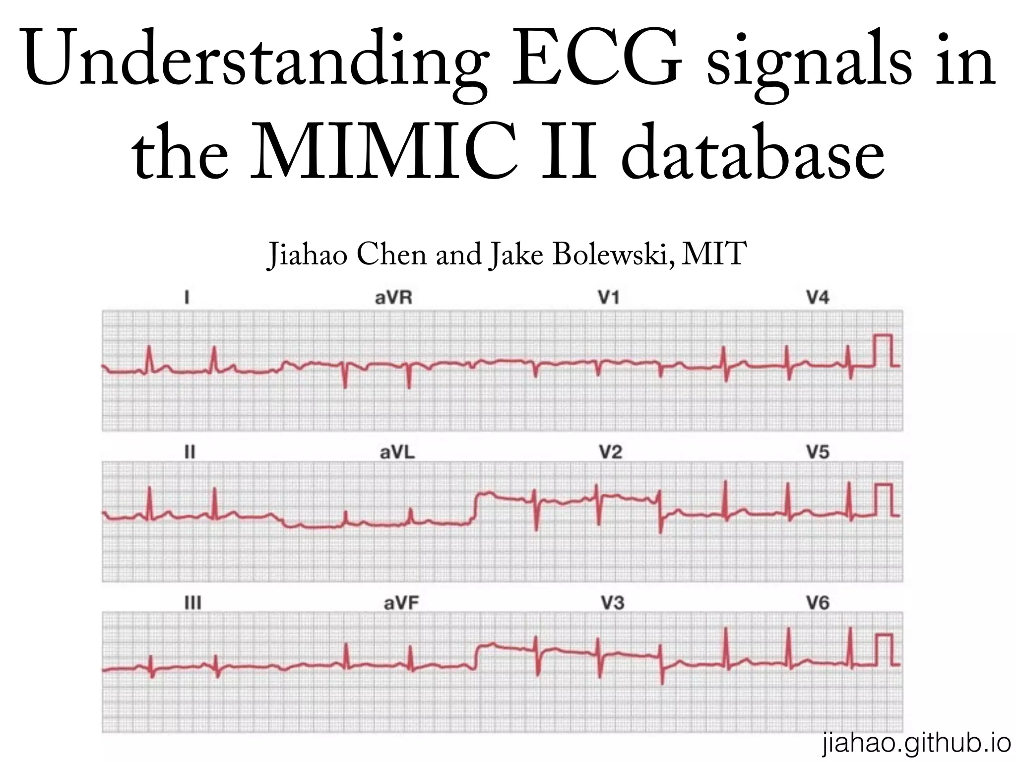 Understanding ECG signals in the MIMIC II database | PDF