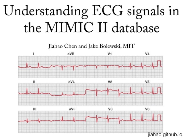 Understanding ECG signals in the MIMIC II database | PDF