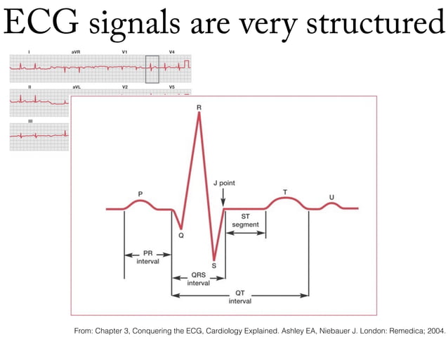 Understanding ECG signals in the MIMIC II database | PDF