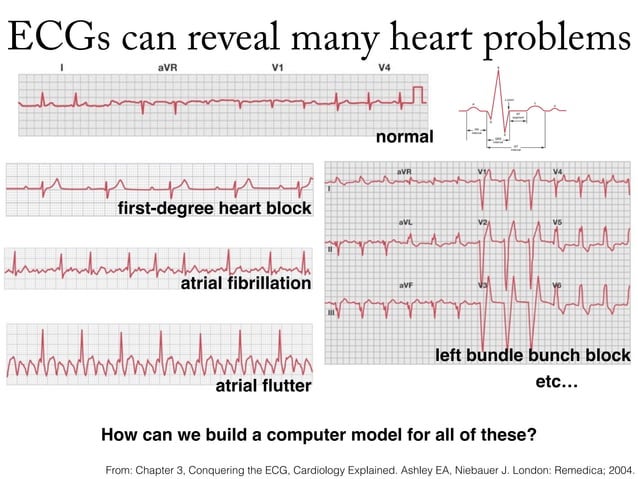 Understanding ECG signals in the MIMIC II database | PDF