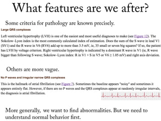 Understanding ECG signals in the MIMIC II database | PDF