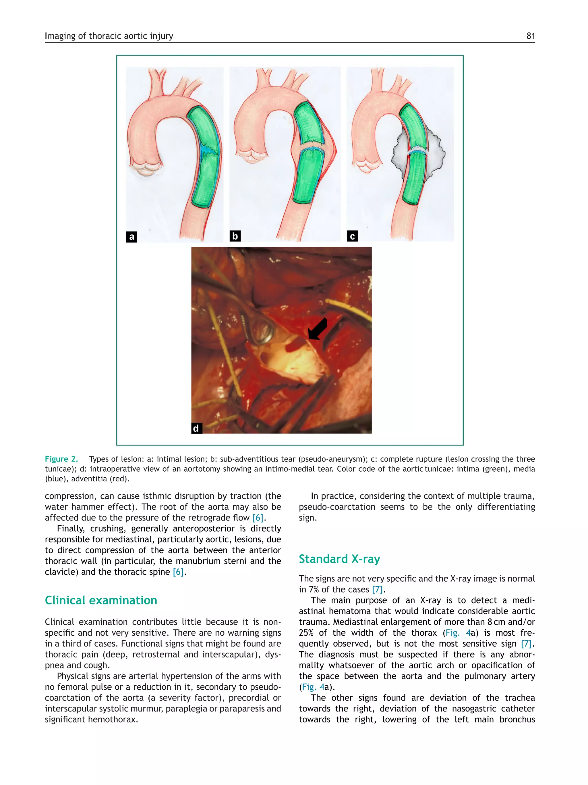 2015 Imaging of thoracic aortic injury | PDF