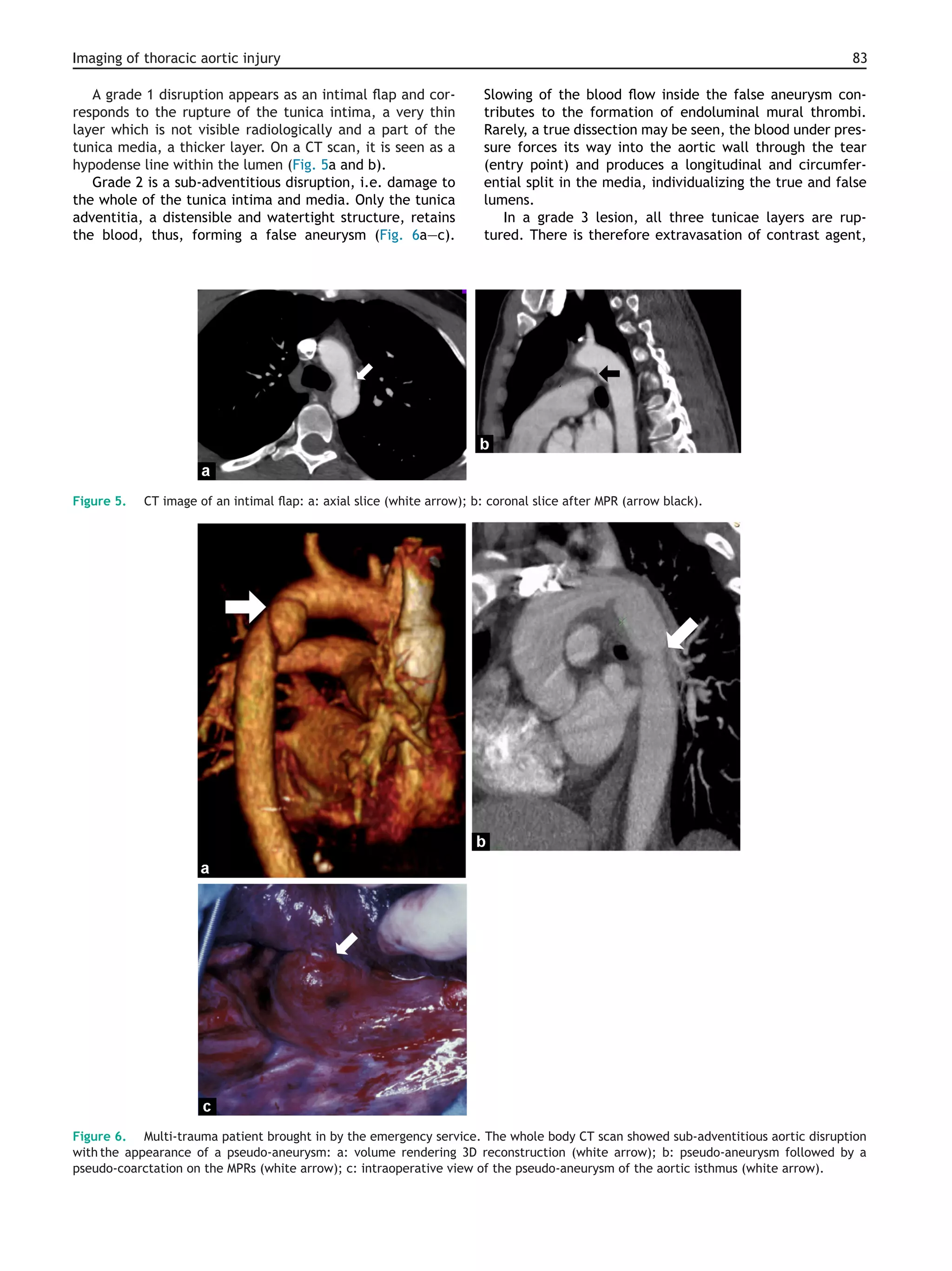 2015 Imaging of thoracic aortic injury | PDF