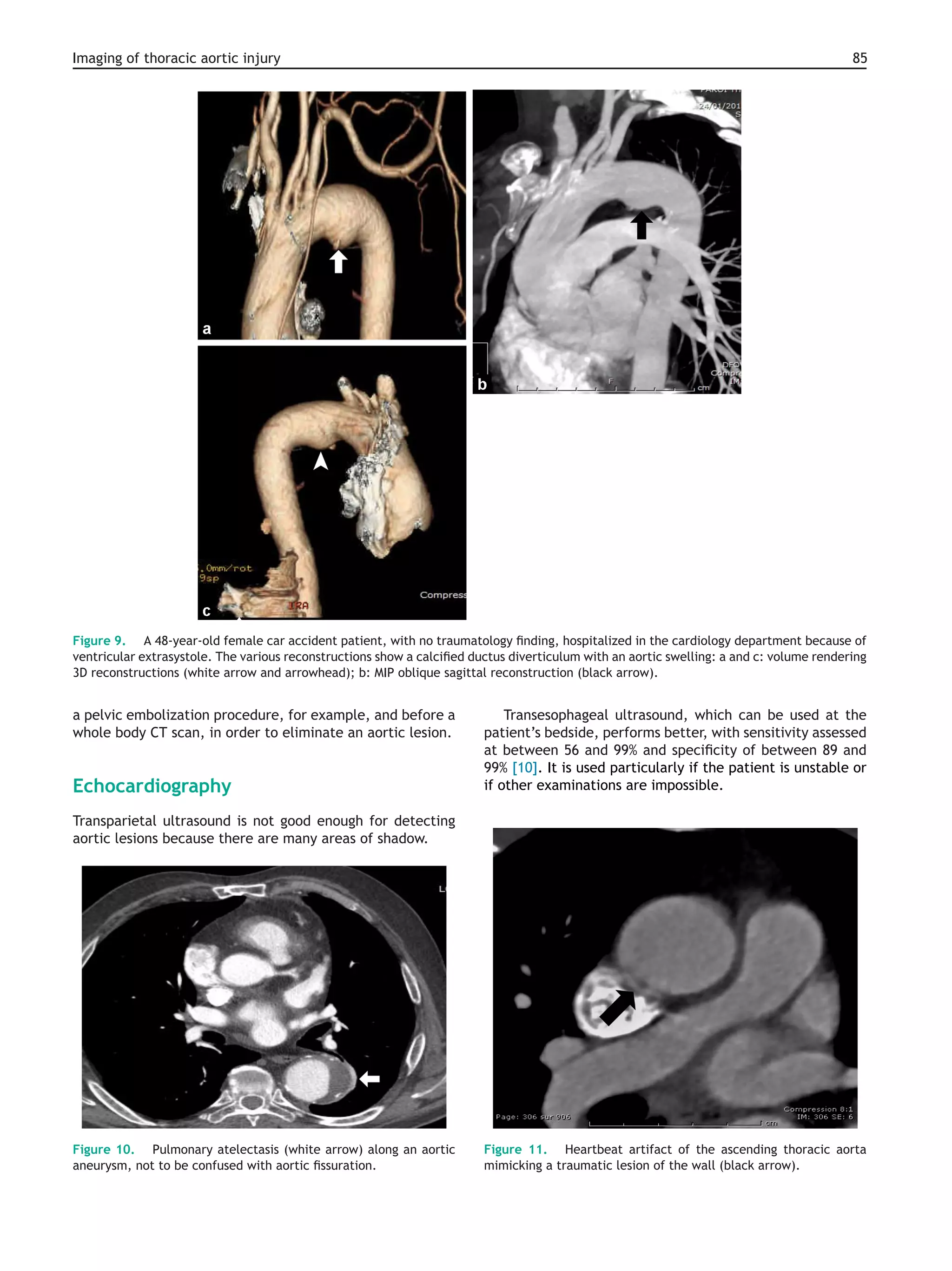 2015 Imaging of thoracic aortic injury | PDF