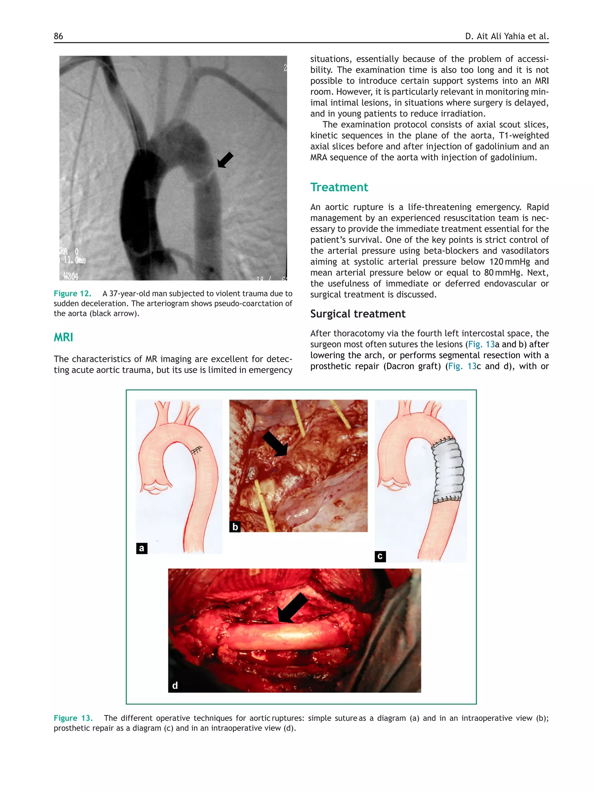 2015 Imaging of thoracic aortic injury | PDF