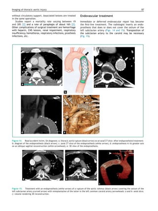 2015 Imaging of thoracic aortic injury | PDF