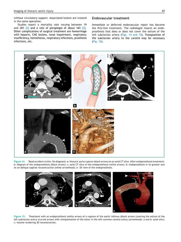 2015 Imaging of thoracic aortic injury | PDF