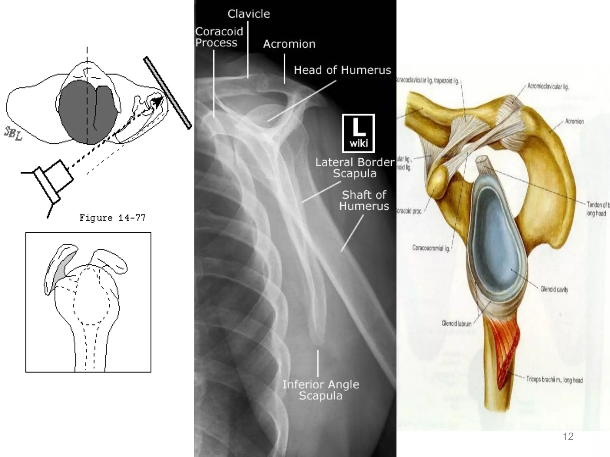 Emergency Radiology: Shoulder & Upper Extremities | PDF