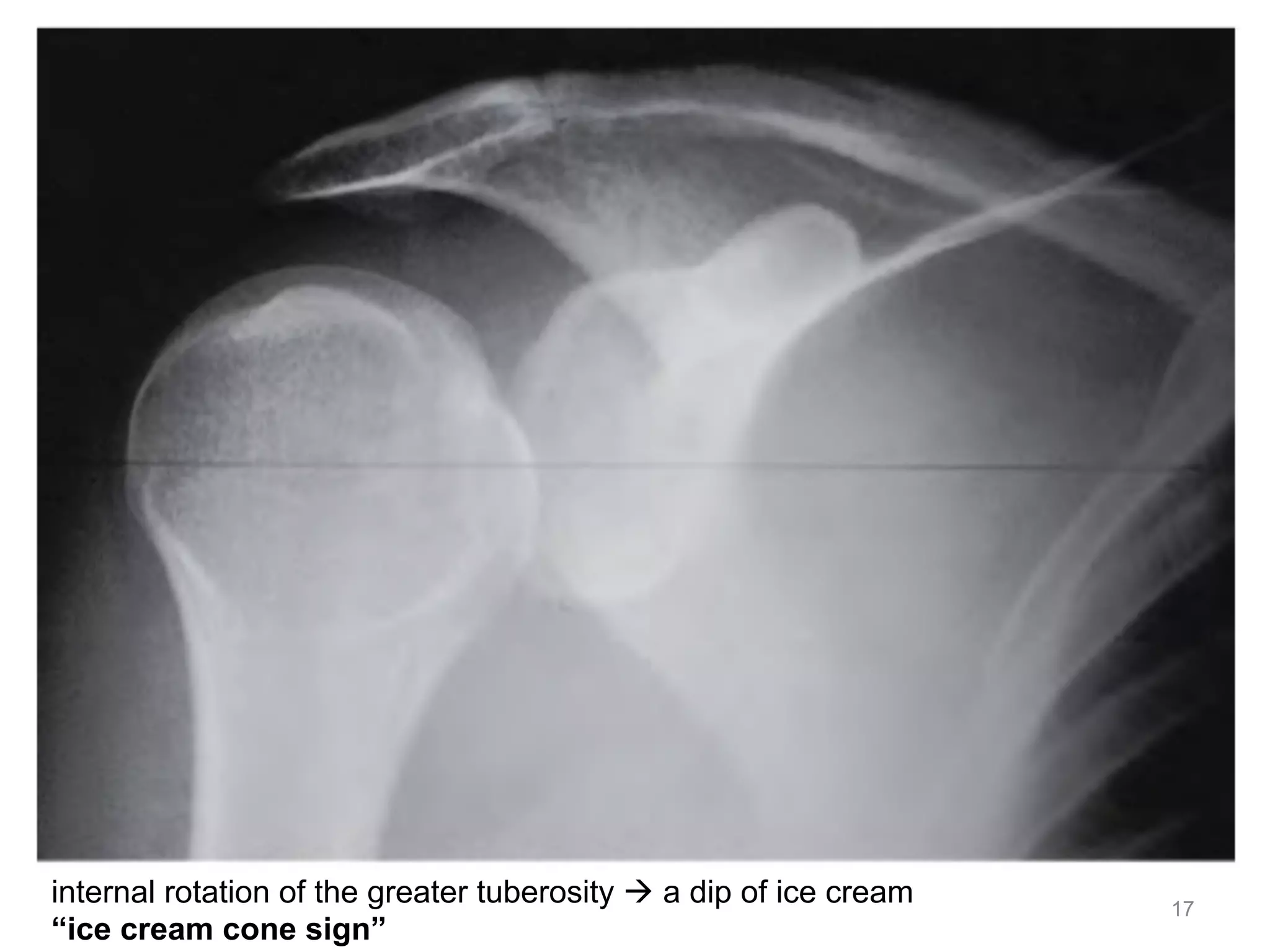 Emergency Radiology: Shoulder & Upper Extremities | PDF