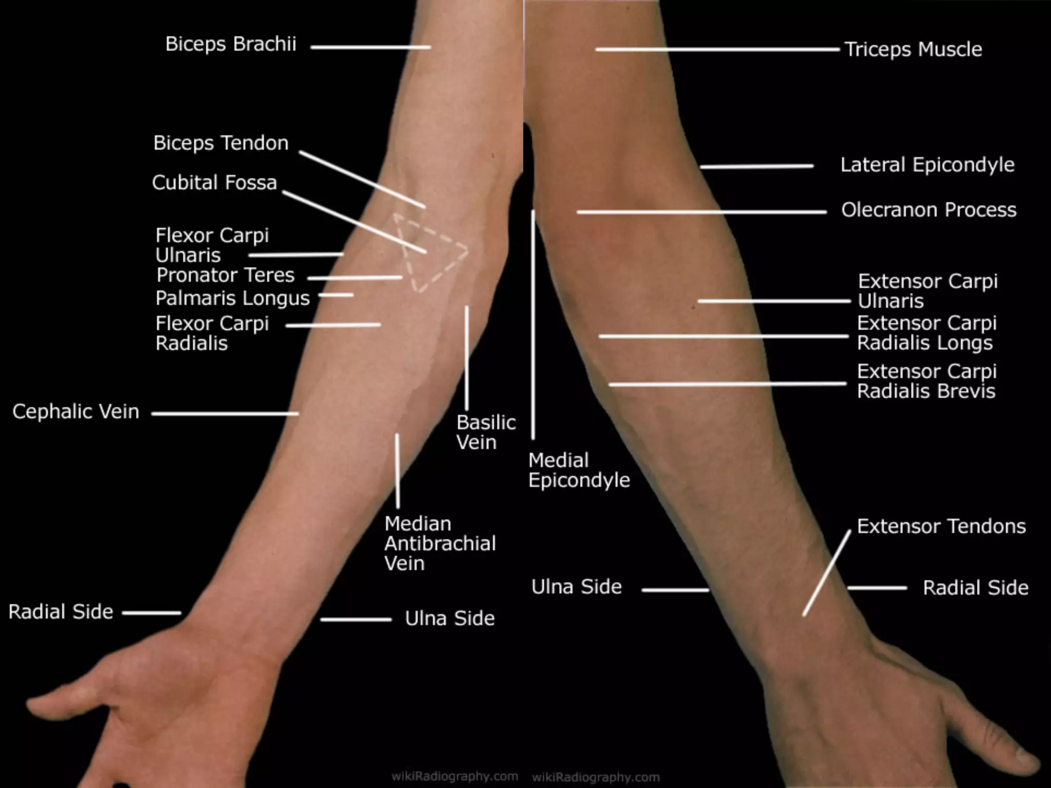 Emergency Radiology: Shoulder & Upper Extremities | PDF