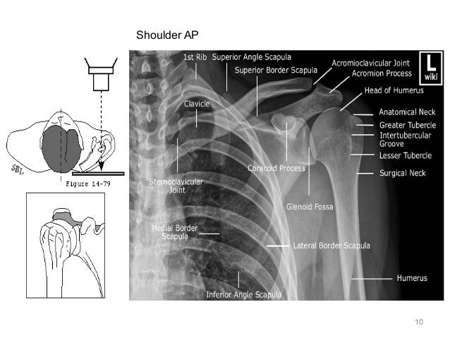 Emergency Radiology: Shoulder & Upper Extremities