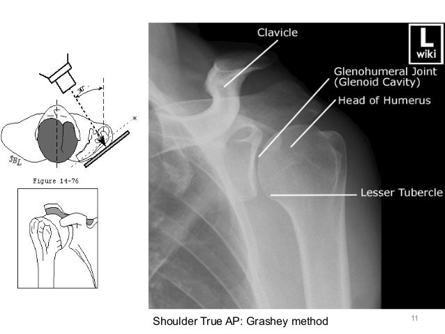 Emergency Radiology: Shoulder & Upper Extremities