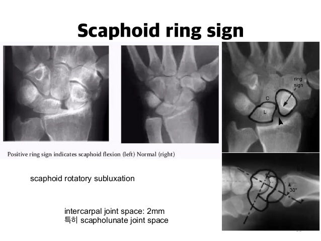 Emergency Radiology: Shoulder & Upper Extremities