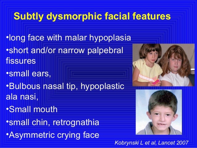 20150918 C.Izzi - 22q11.2 Microdeletion Syndrome: Understanding the