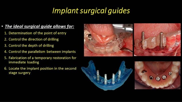 Simplified Computer Guided Surgery Preview