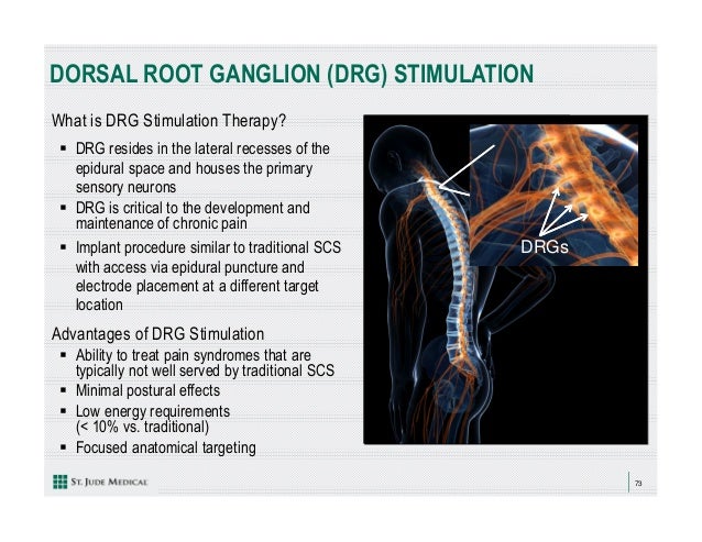 Anyone heard of DRG (dorsal root ganglia) stimulation? : r/ChronicPain