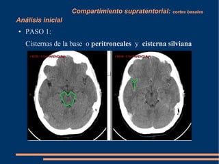 2015 supratentorial i tc | PDF