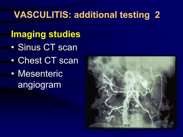 2015 mangement of Systemic Vasculitis.ppt