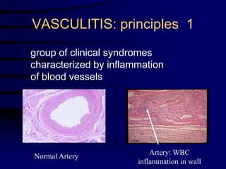 2015 mangement of Systemic Vasculitis.ppt